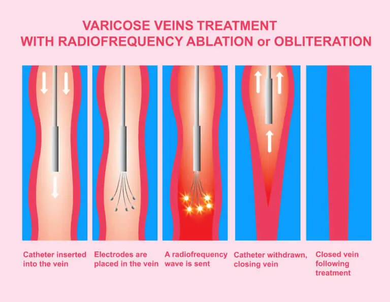 New Vein Treatments You Should Know About - Edward G. Mackay, MD, FACS ...