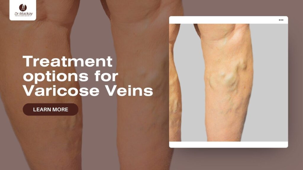 Bulging Veins in the Legs Causes & Treatment by Dr. Mackay