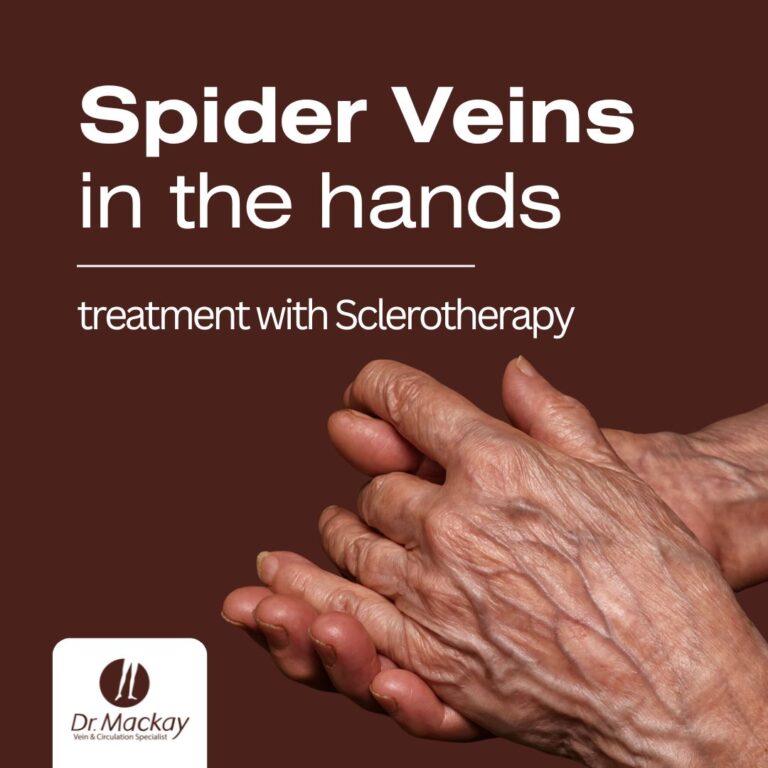 Hand Sclerotherapy for Spider Veins by Dr. Mackay in Pinellas FL